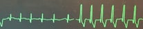 When Should Ventricular Premature Complexes (VPCs) Be Treated?
